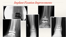 This Just In... - Factors Influencing Longevity in Ankle Arthroplasty