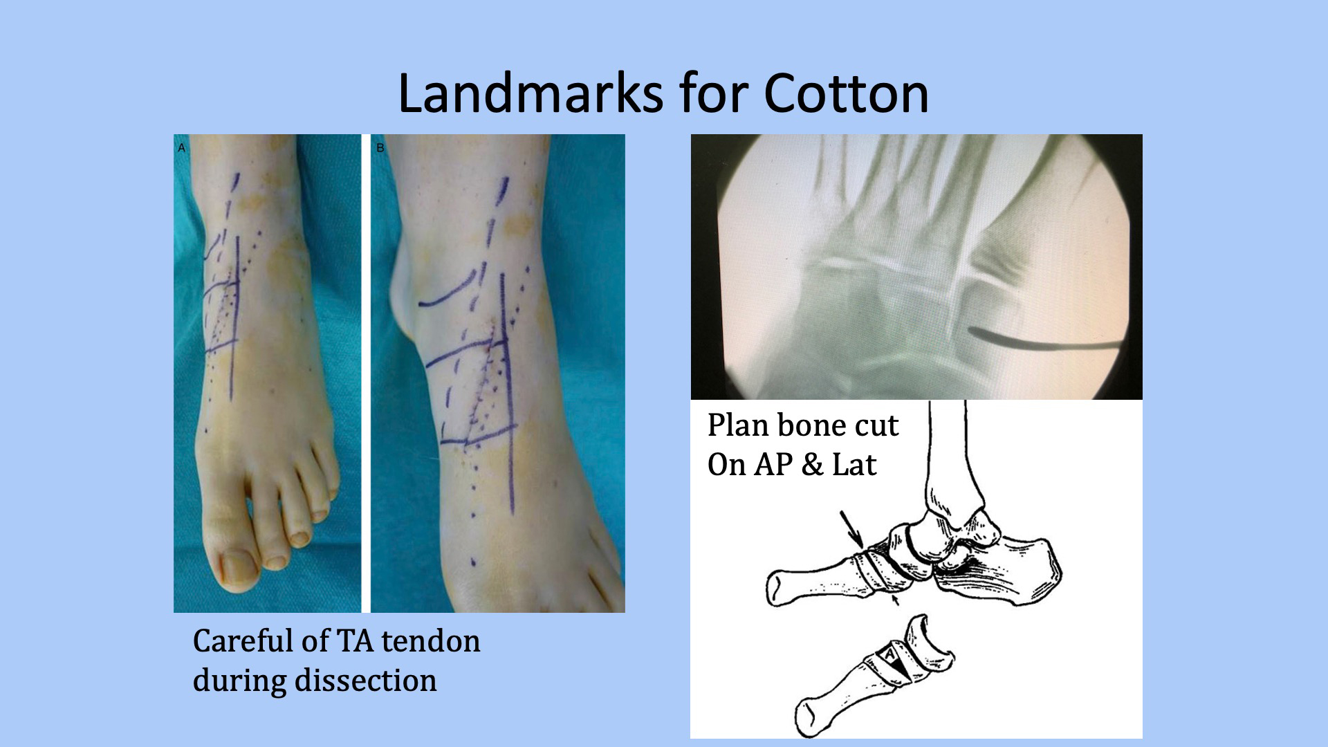This Just In... - Calcaneal and Cotton Osteotomies for Flatfoot Correction