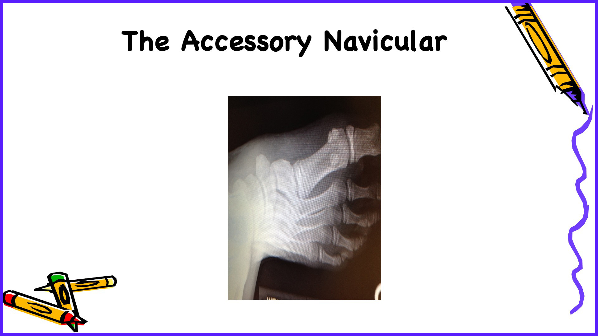 This Just In... - The Accessory Navicular